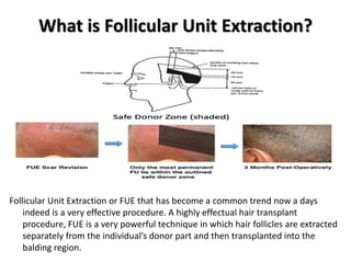 Stages of FUE Process | PPT