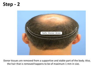 Stages of FUE Process | PPT