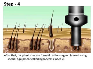 Stages of FUE Process | PPT