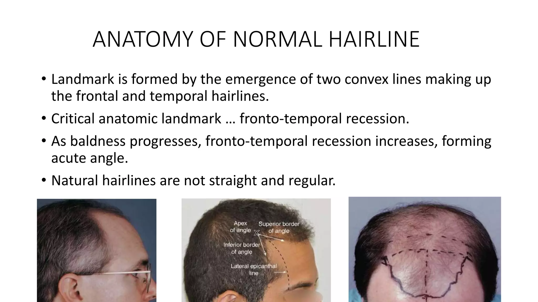 Hair transplantation | PPTX