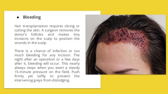 Hair Transplant Before And After | PPT