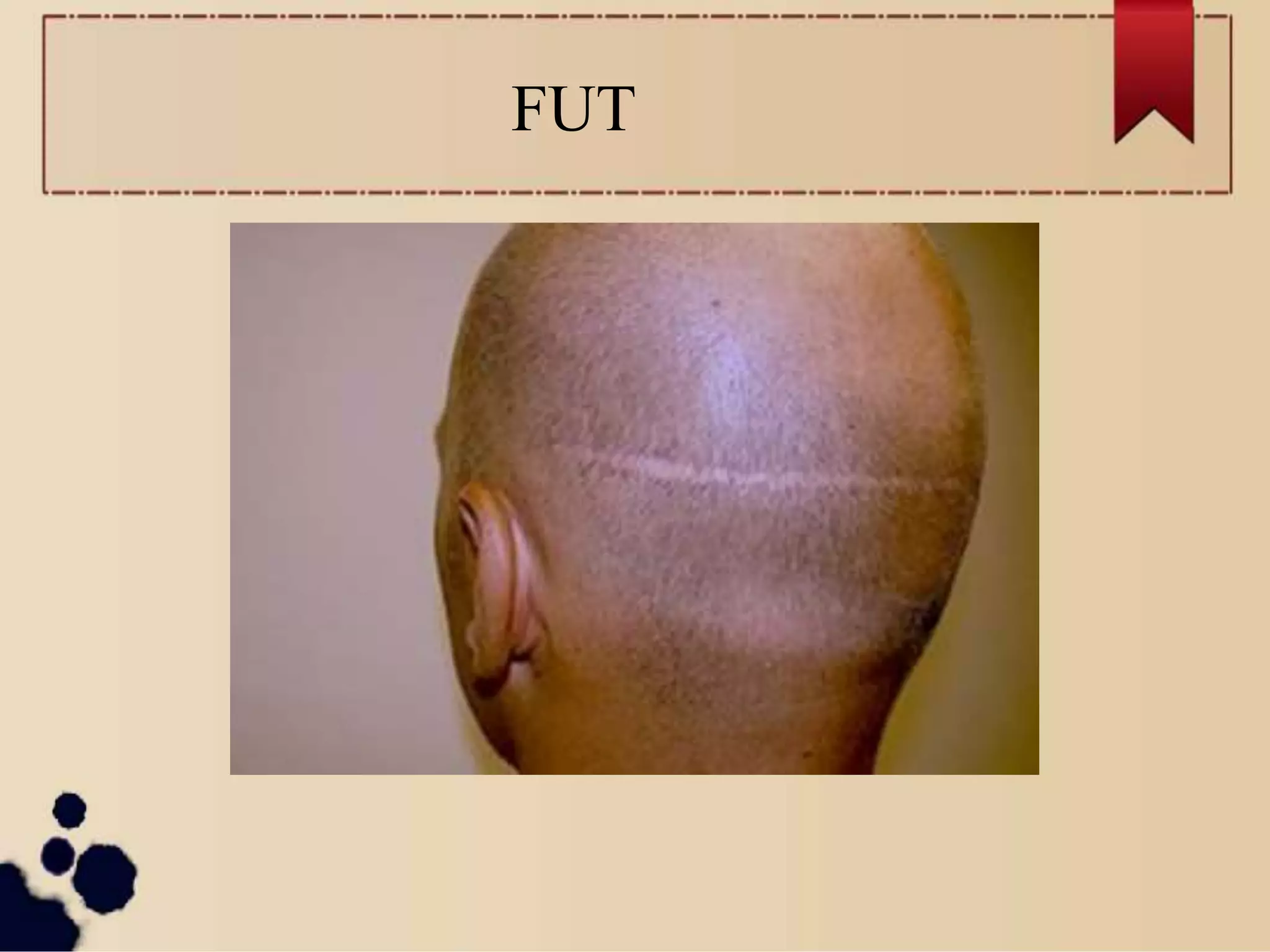 Hair transplant ppt | PPTX