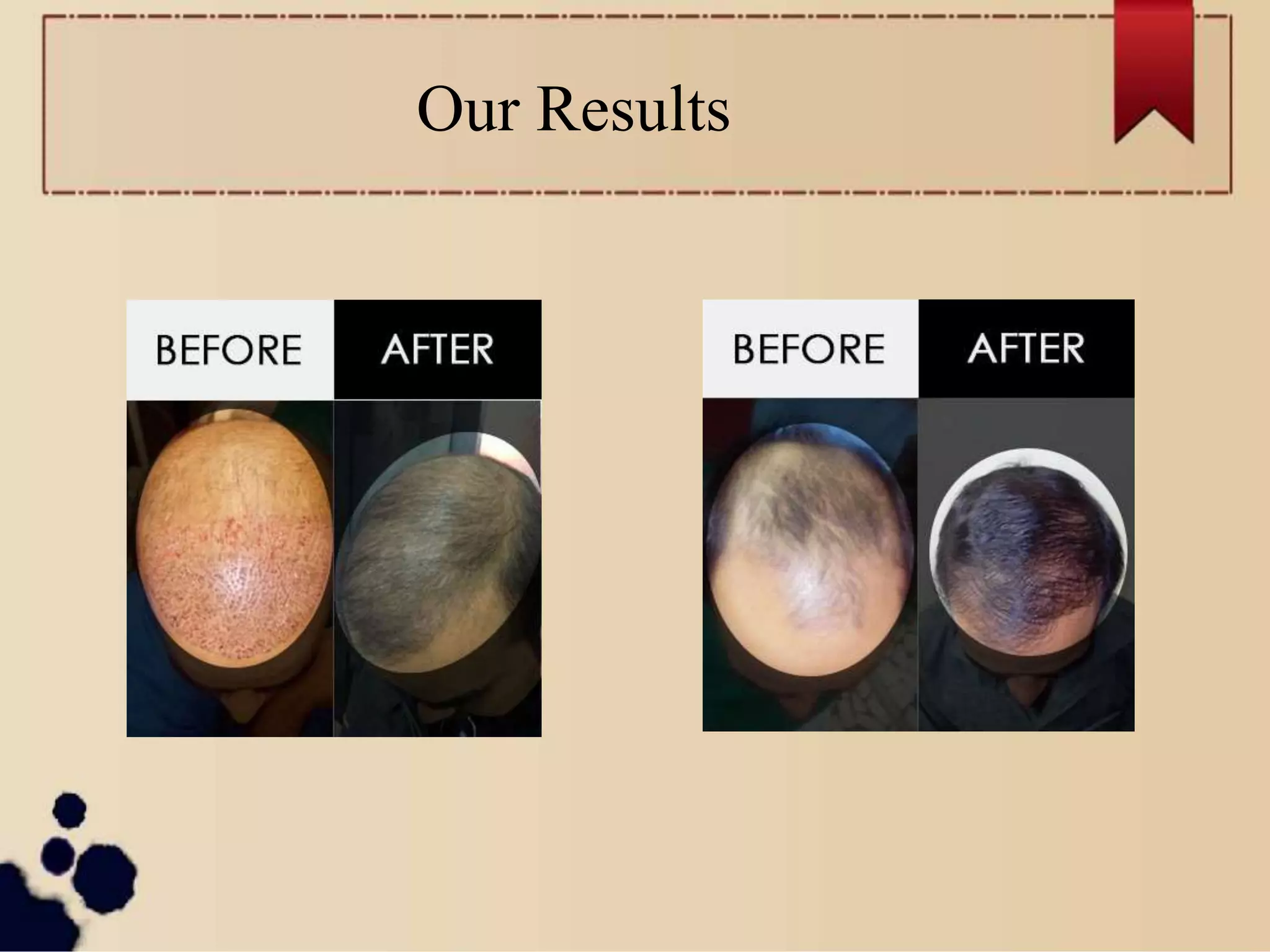 Hair transplant ppt | PPTX