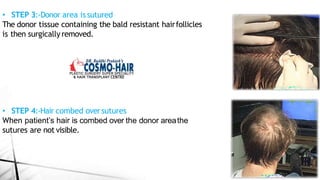Hair transplant surgery | PPTX