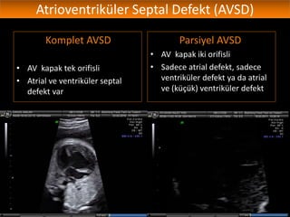 ASD,AVSD ,VSD | PPT