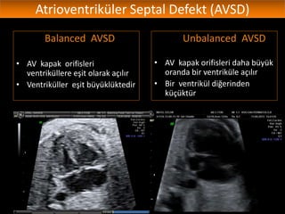 ASD,AVSD ,VSD | PPT