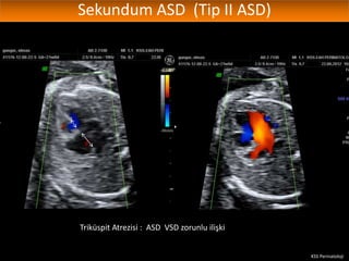ASD,AVSD ,VSD | PDF