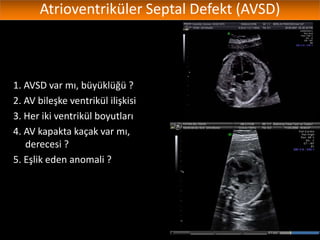 ASD,AVSD ,VSD | PPT