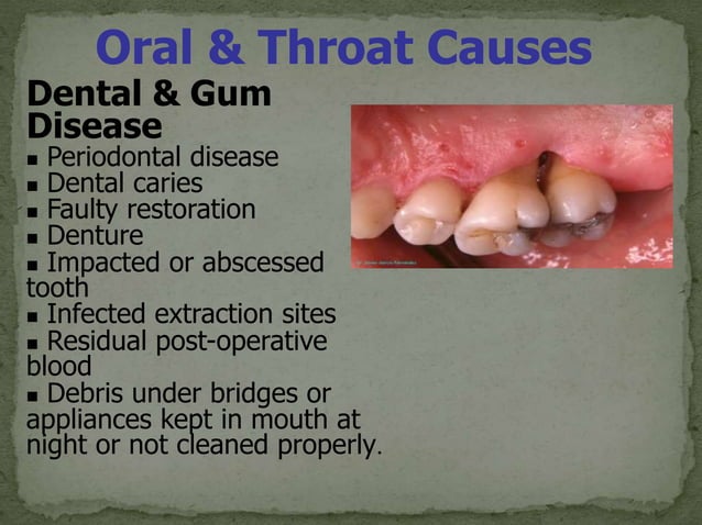Halitosis | PPTX | Ear, Nose and Throat Conditions | Diseases and ...