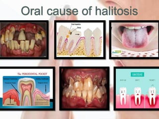 Halitosis DR SINDHURA.pptx