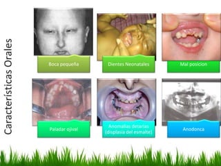 Sindrome de Hallerman streiff | PPT