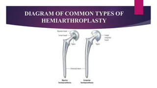 HEMIARTHROPLASTY FEDERAL TEACHING HOSPITAL KATSINA.pdf