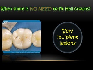 Hall technique | PPT