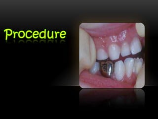 Hall technique | PPTX