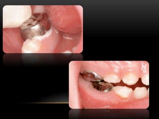 Hall technique | PPTX