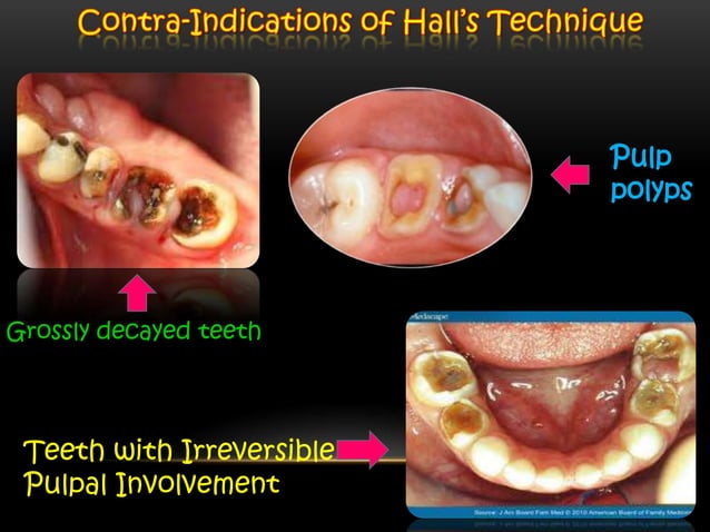 Hall technique | PPT