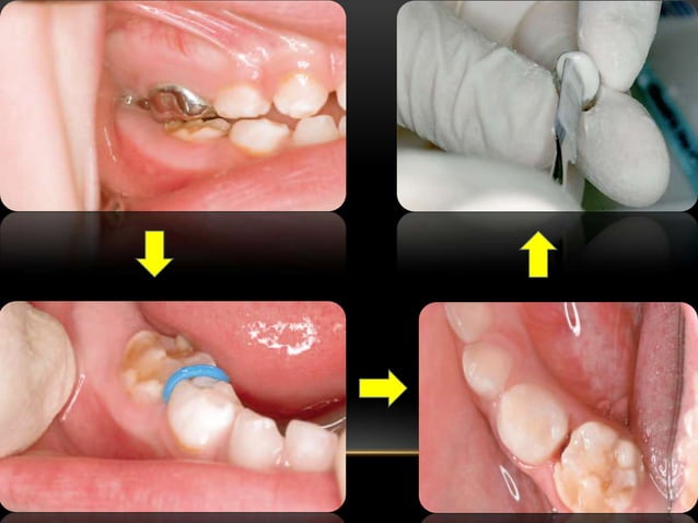 Hall technique | PPT