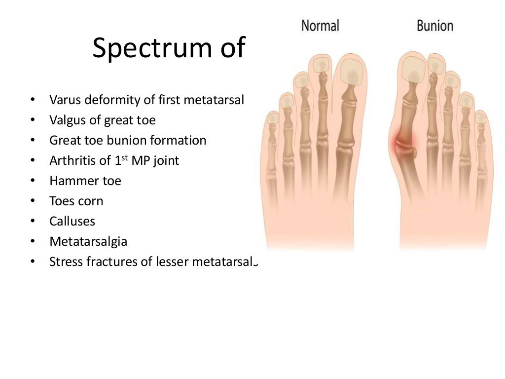 Hallux by Harpreet Singh