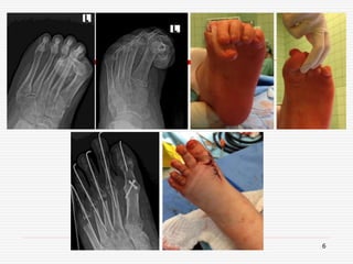 Hallux flexus + Clawed hallux | PPT