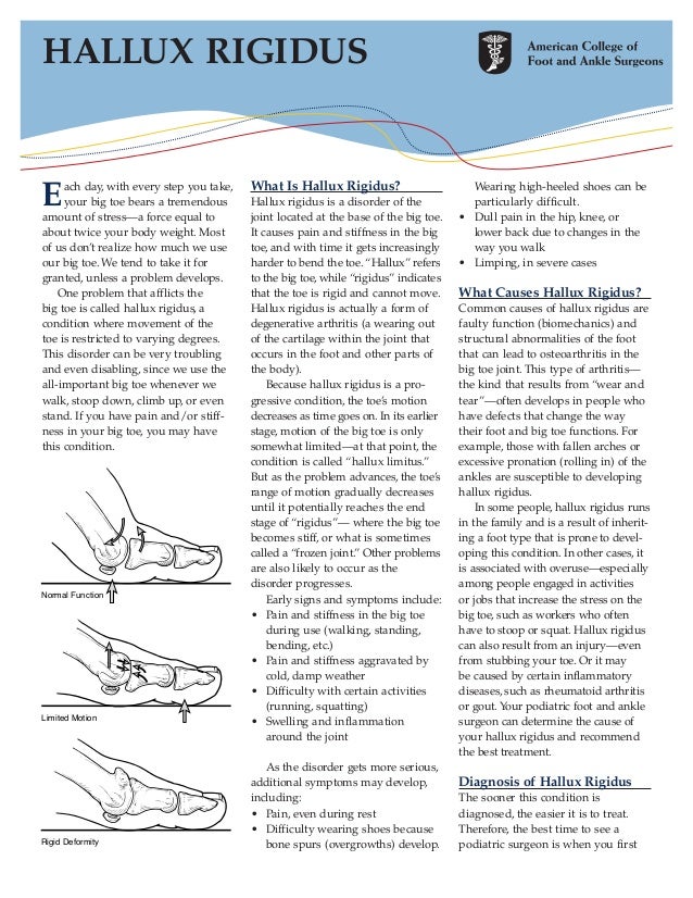 Hallux Rigidus Anatomy Hallux Rigidus | Radiology Reference Article