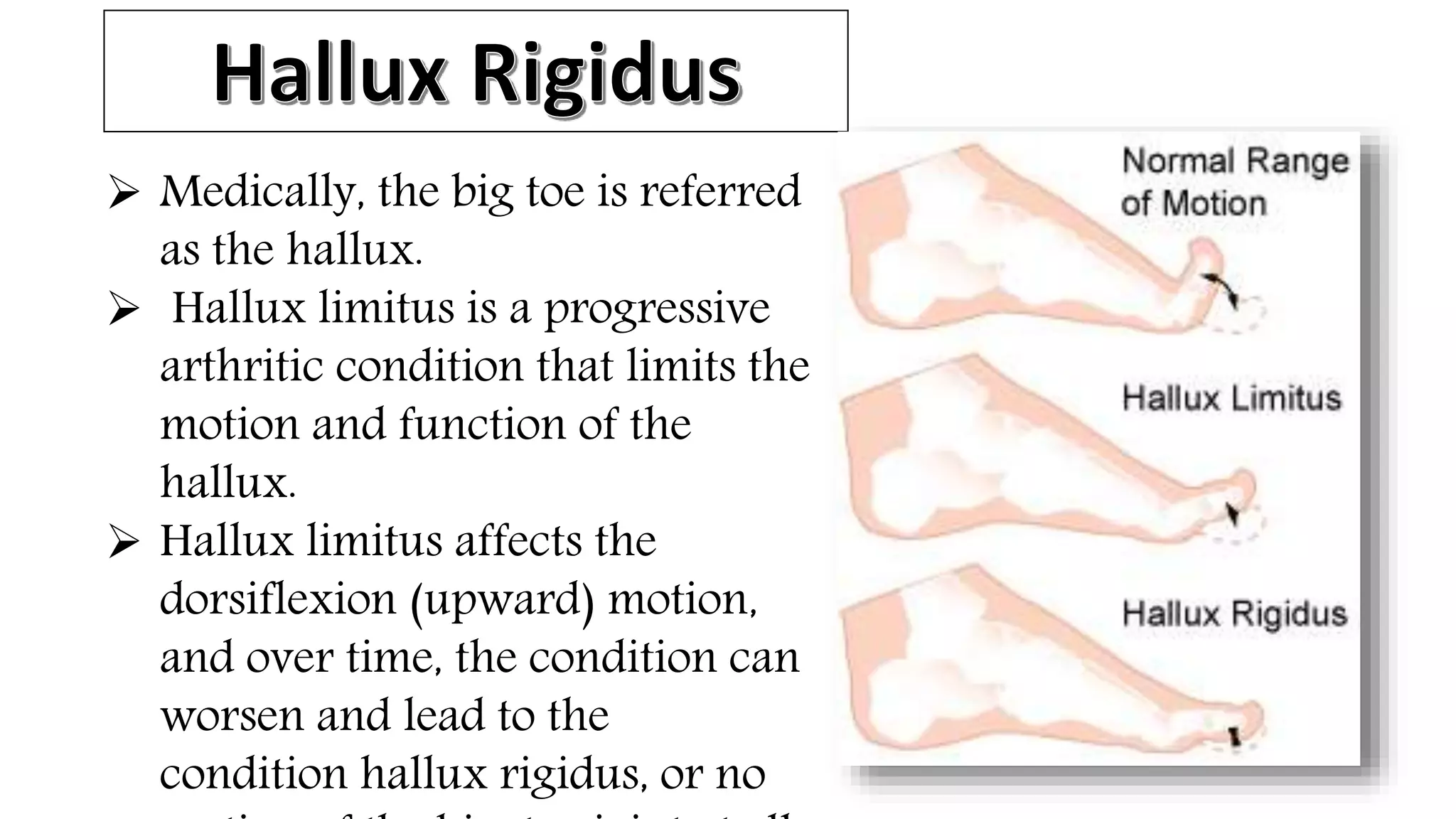 Hallux rigidus | PPTX