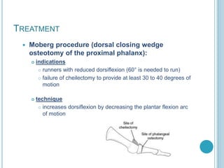 Hallux rigidus | PPTX