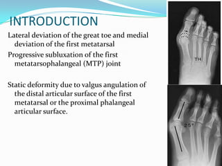 Hallux valgus UG lecture | PPTX