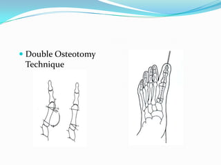 Hallux valgus UG lecture | PPTX