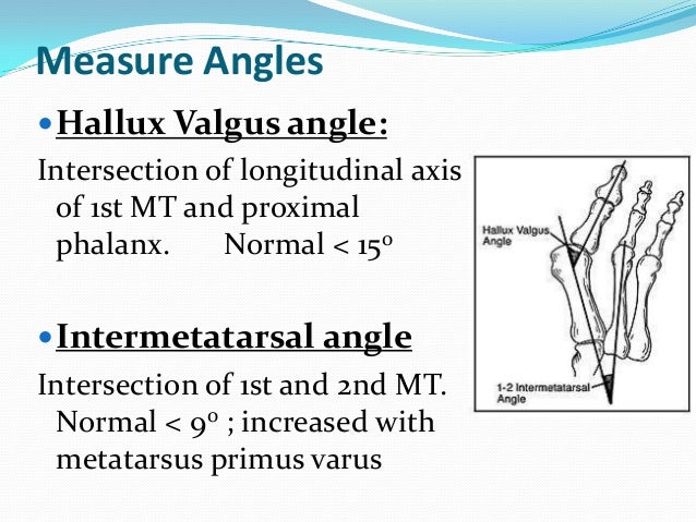 Hallux valgus UG lecture