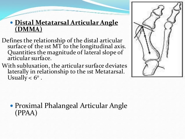 Hallux valgus UG lecture