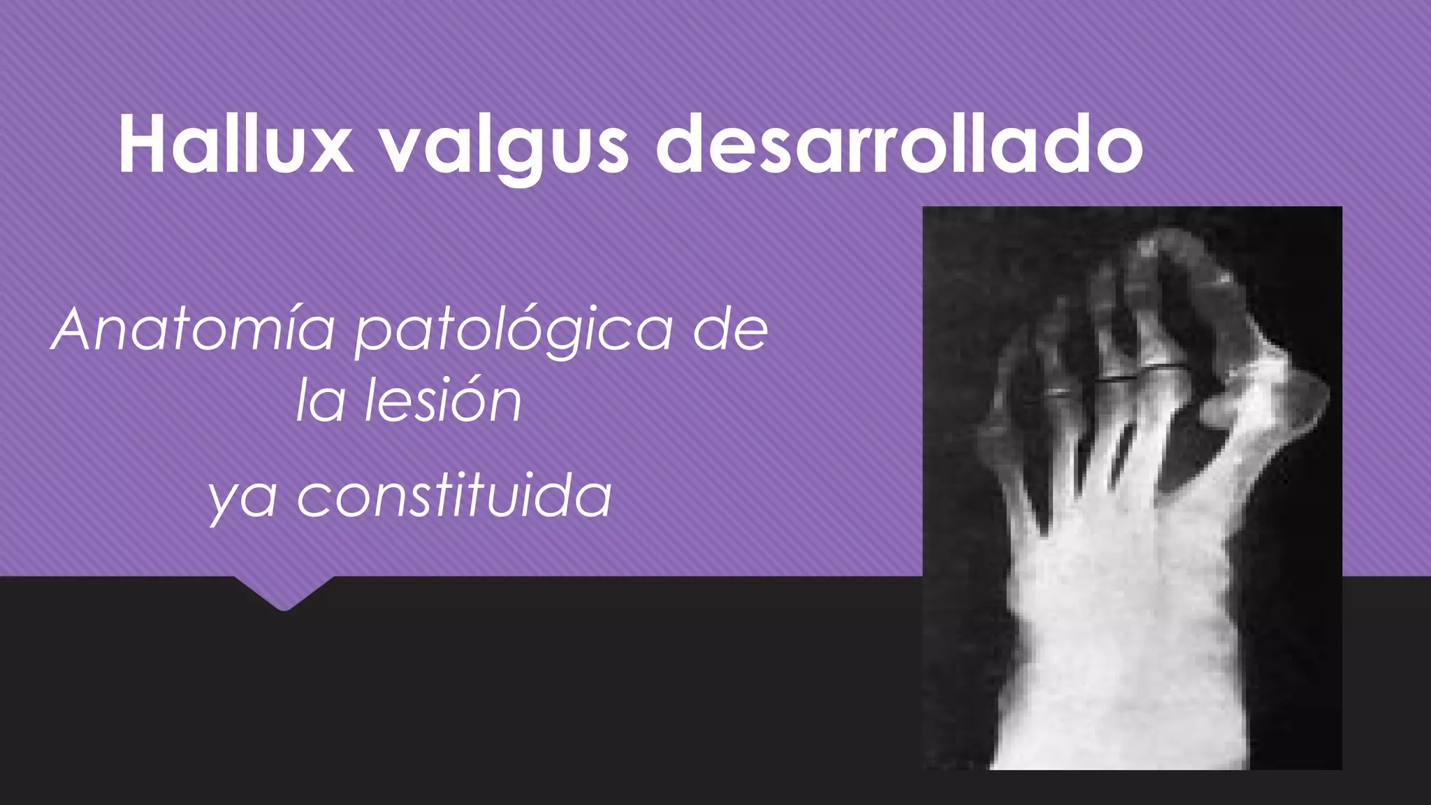 Hallux valgus | PPT