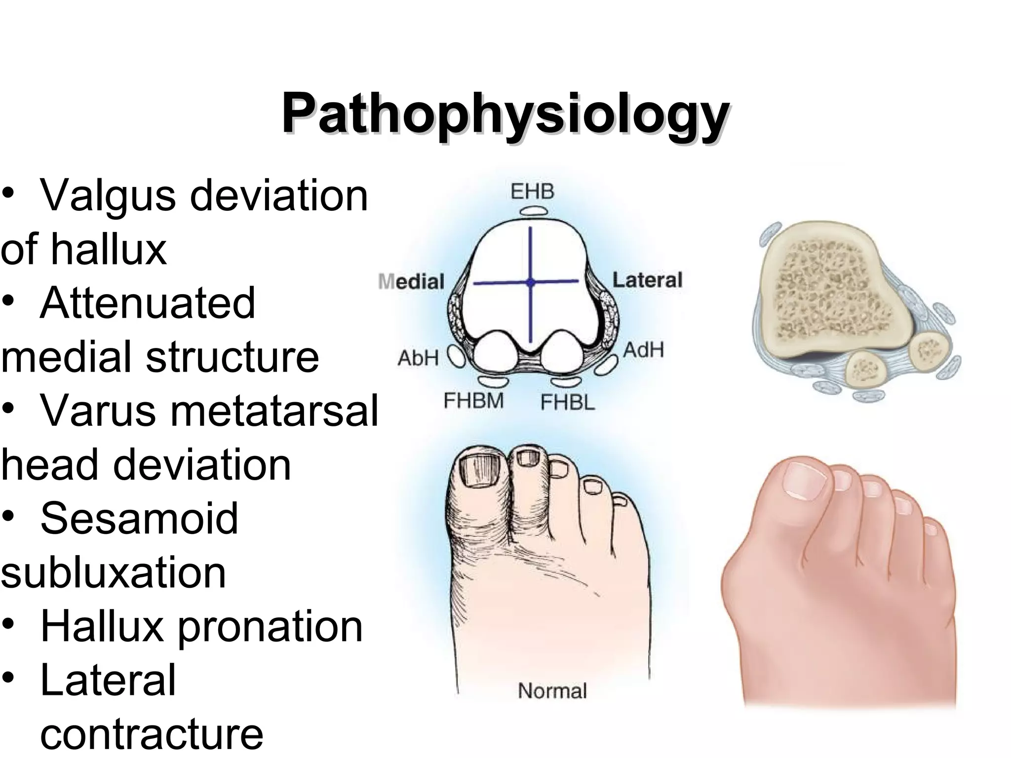 Hallux valgus | PPT