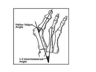 Hallux valgus | PPT
