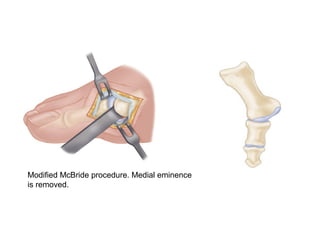Hallux valgus | PPT