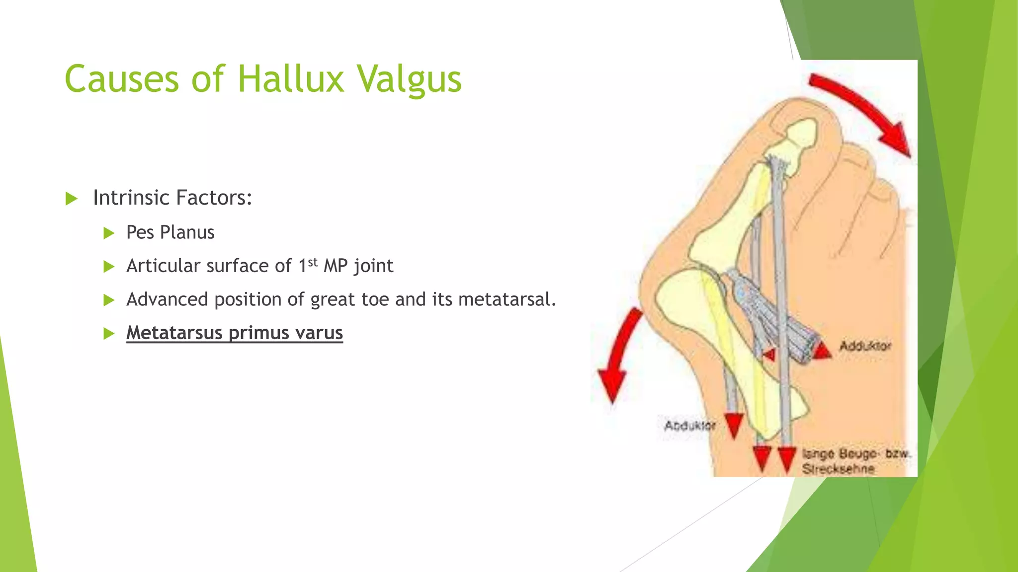 Hallux valgus | PPTX