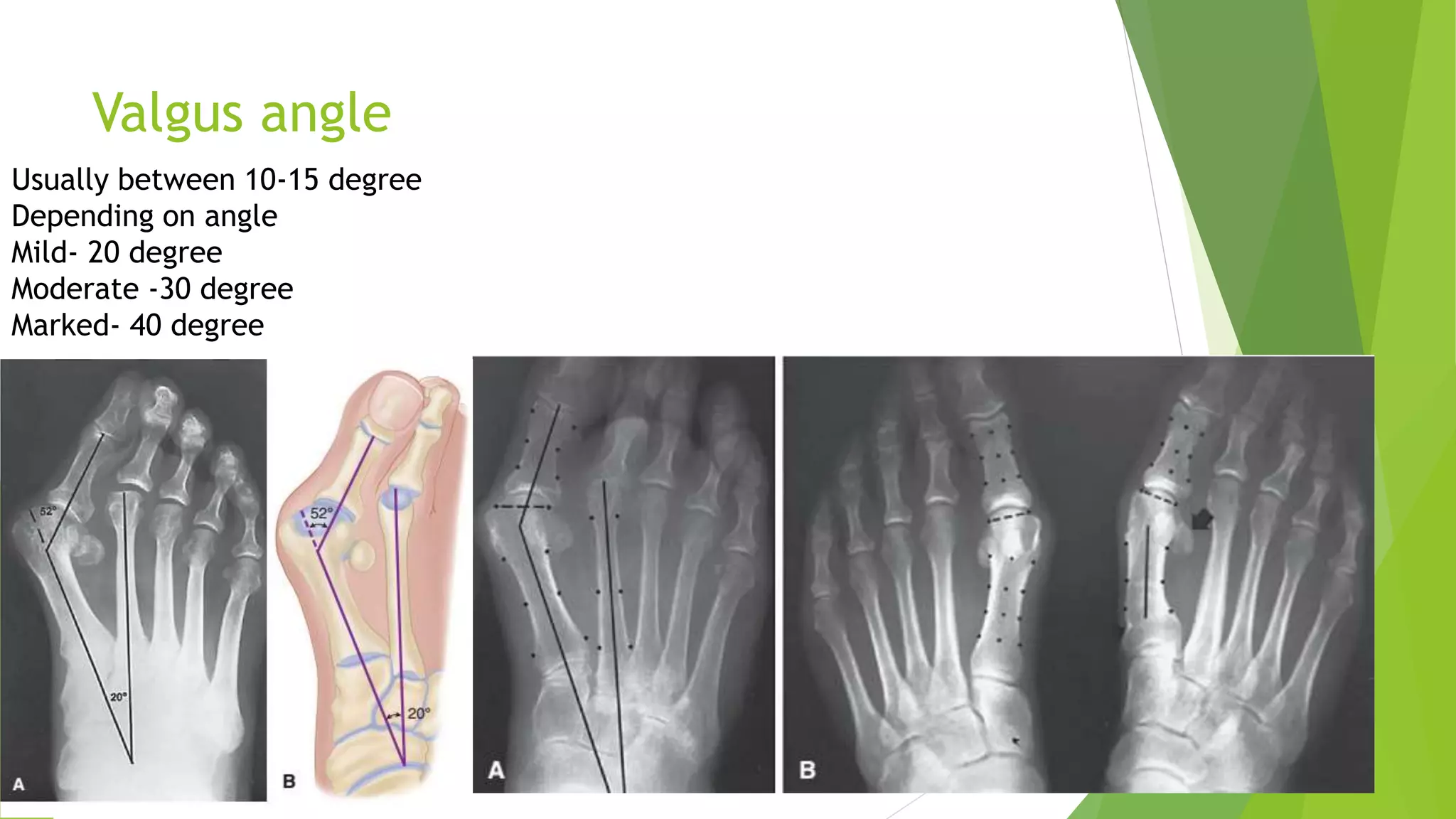 Hallux valgus | PPTX