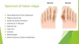 Hallux valgus | PPTX
