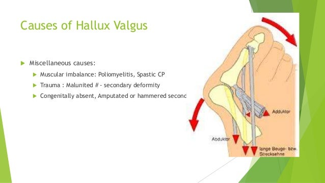 Hallux valgus