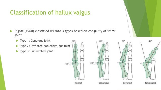 Hallux valgus