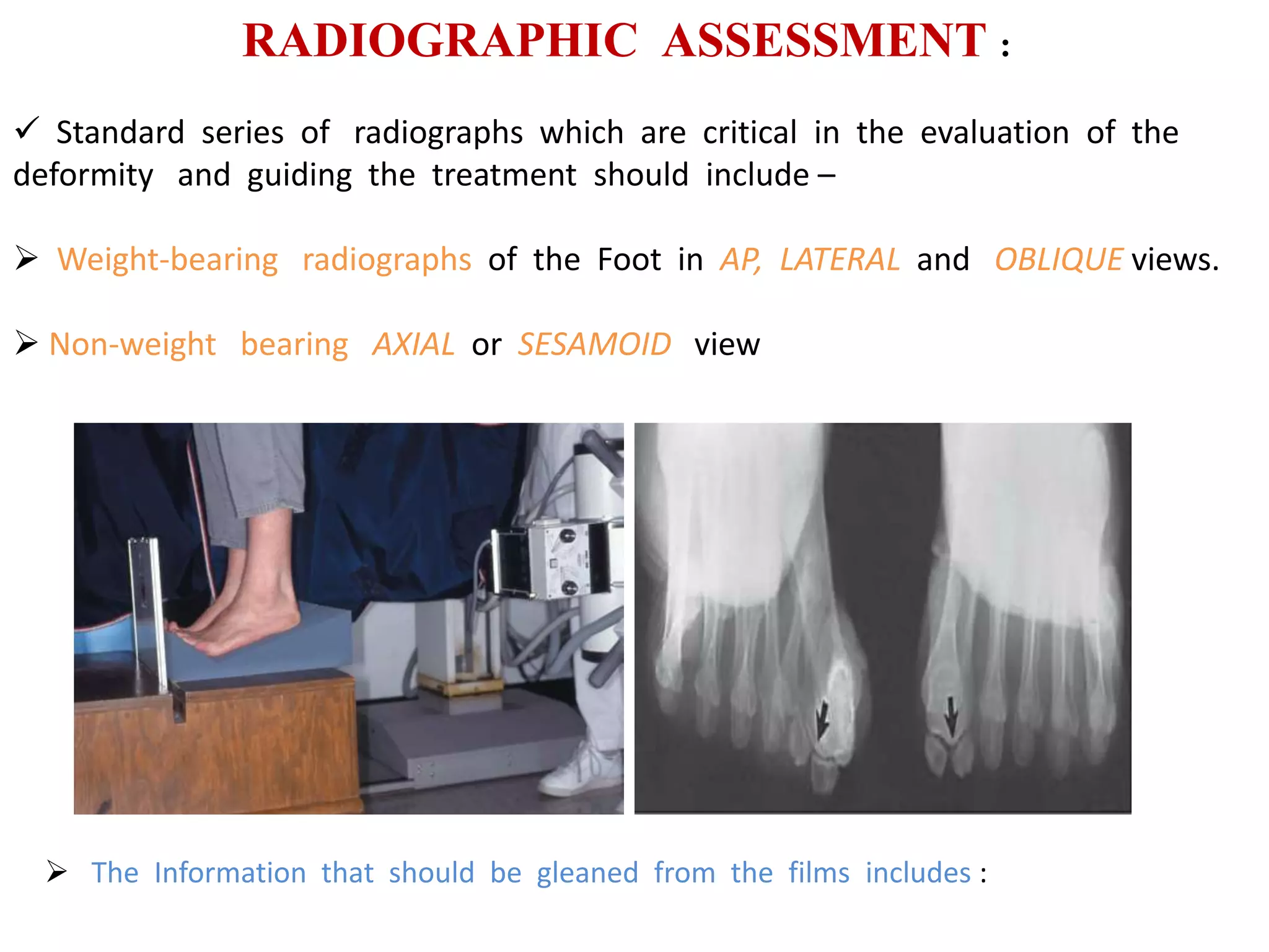Hallux Valgus - A Detailed Outline | PPTX