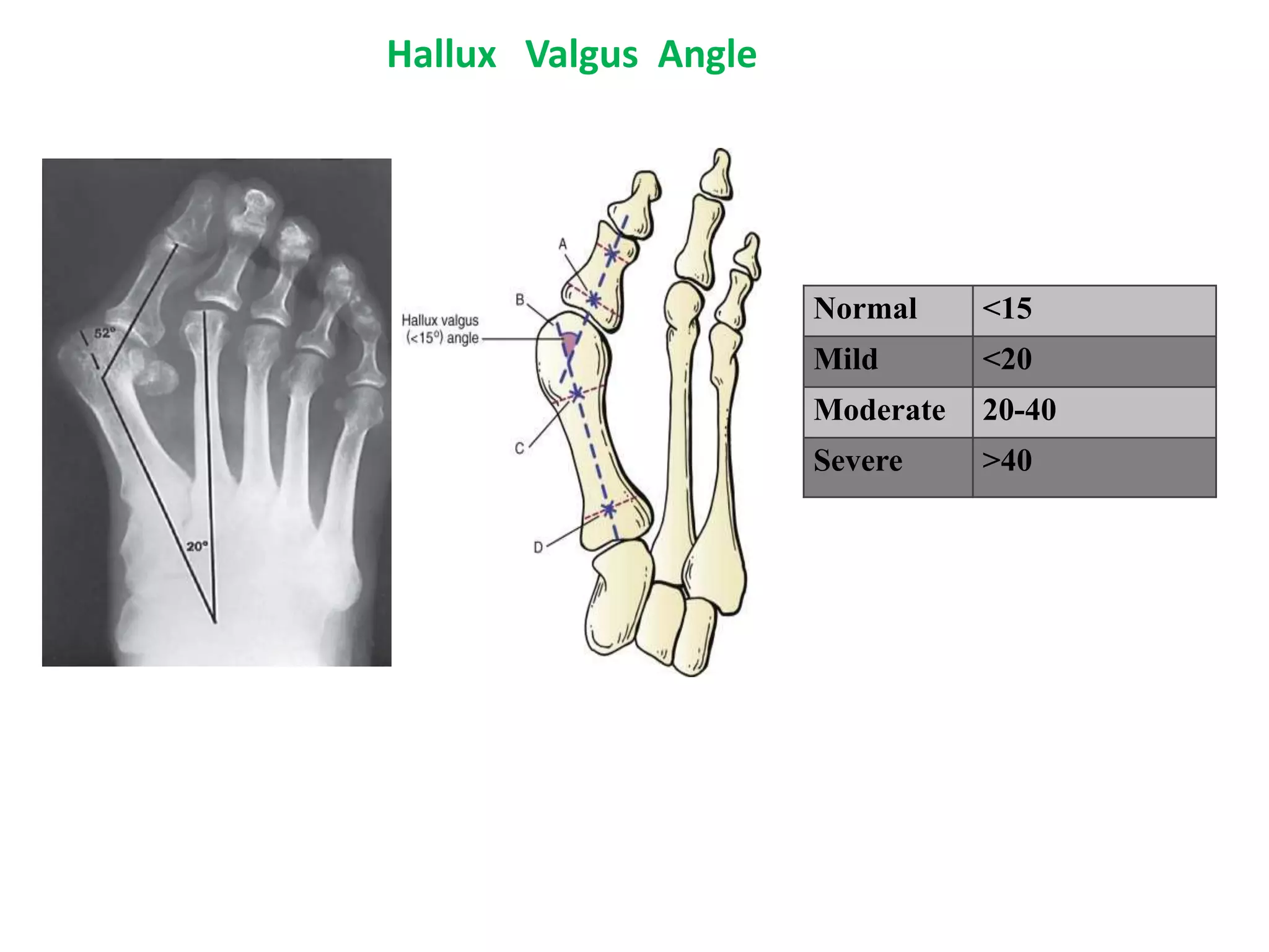 Hallux Valgus - A Detailed Outline | PPTX