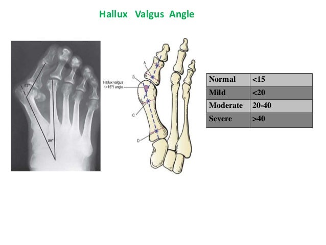 Hallux Valgus Angle
