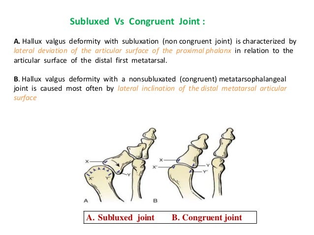 Hallux Valgus - A Detailed Outline