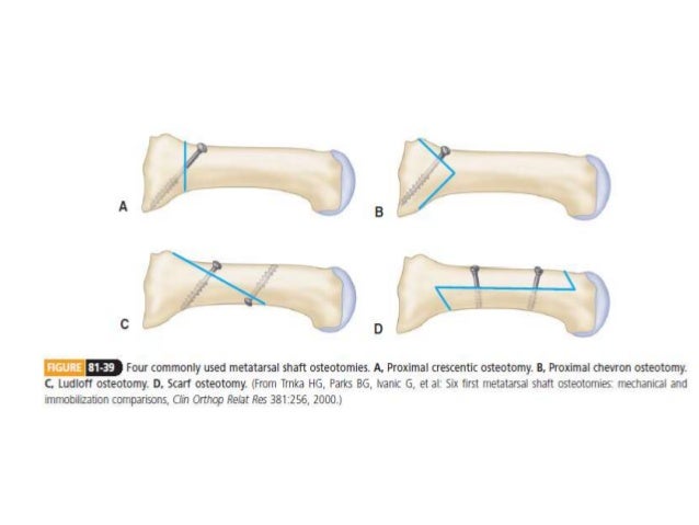 Hallux Valgus - A Detailed Outline