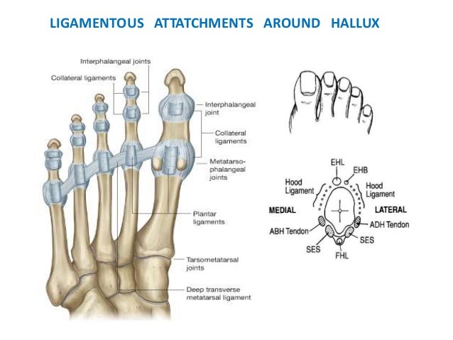 Hallux Valgus A Detailed Outline