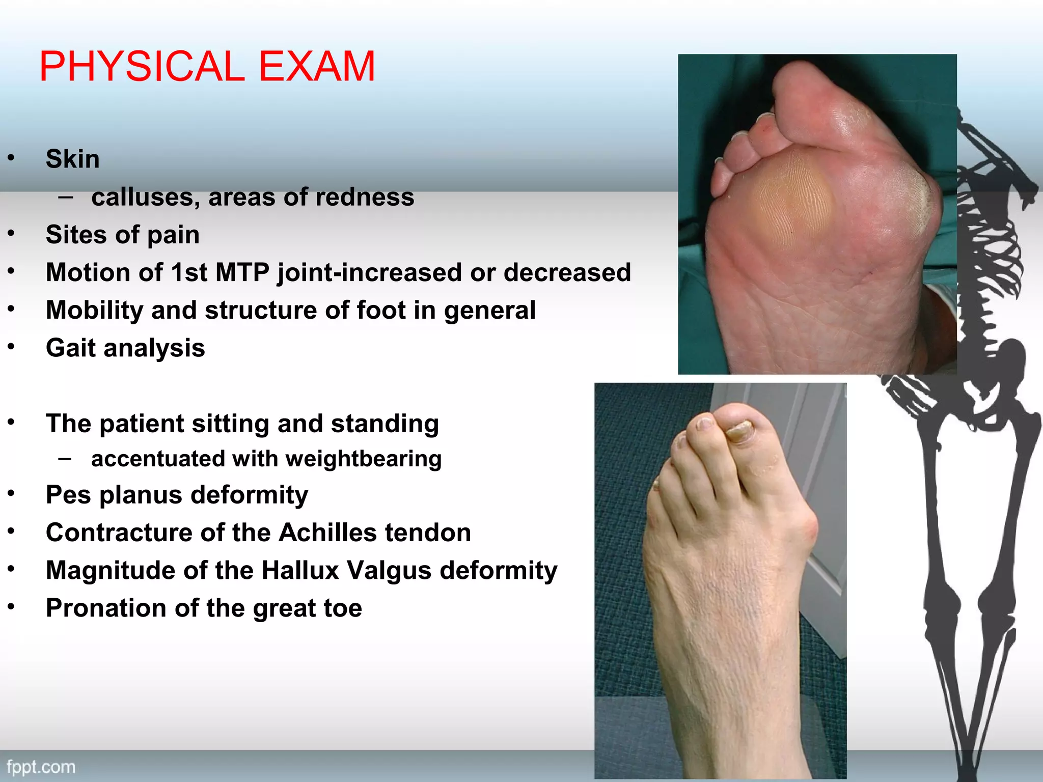 Hallux valgus.pptx