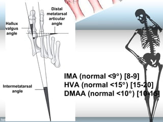 Distal Metatarsal Articular Angle