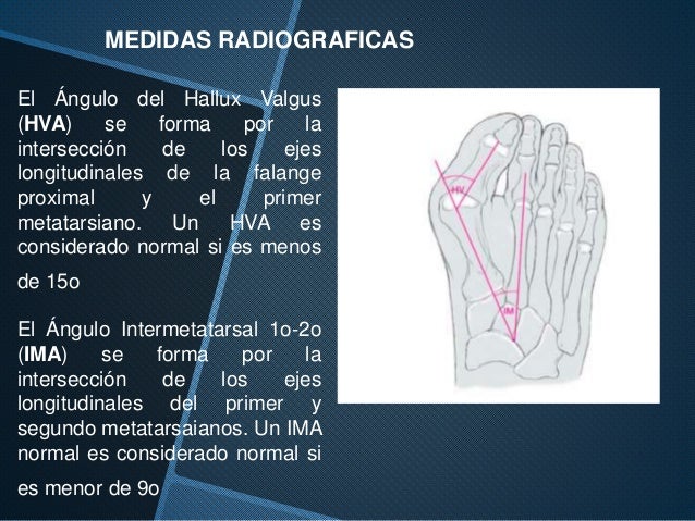 Hallux valgus