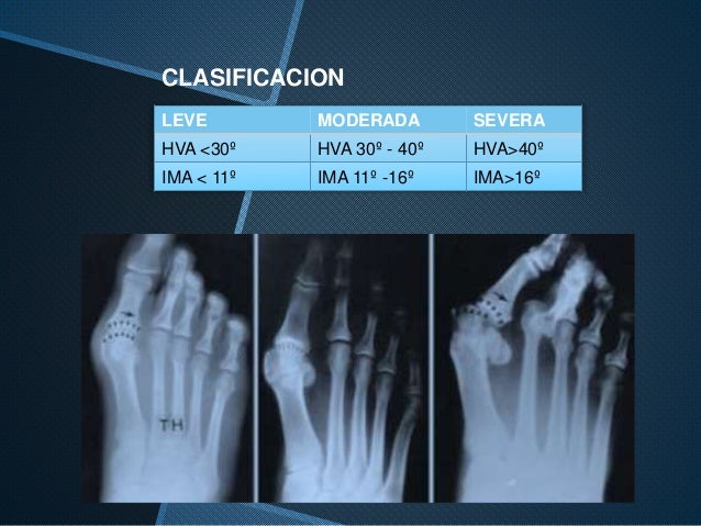 Hallux valgus