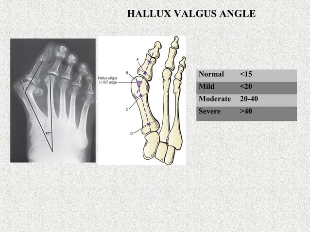 Hallux valgus | PPT